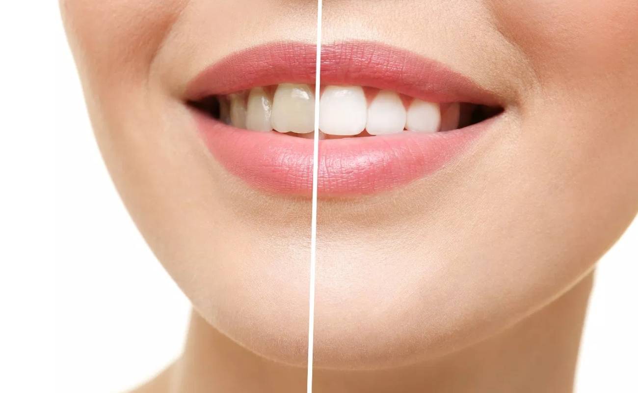 Teeth Whitening and it's Pros and Cons - Daily Health Trends Diet ...